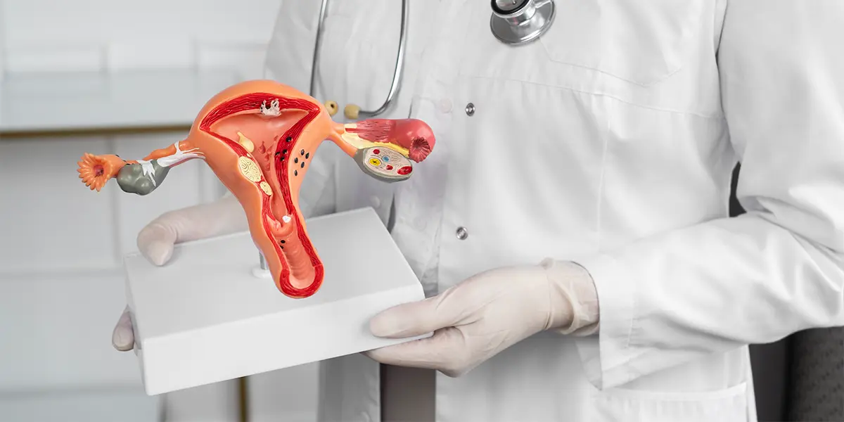 Ovarian Cyst Surgery in Iran with Top Experts at Mortaz